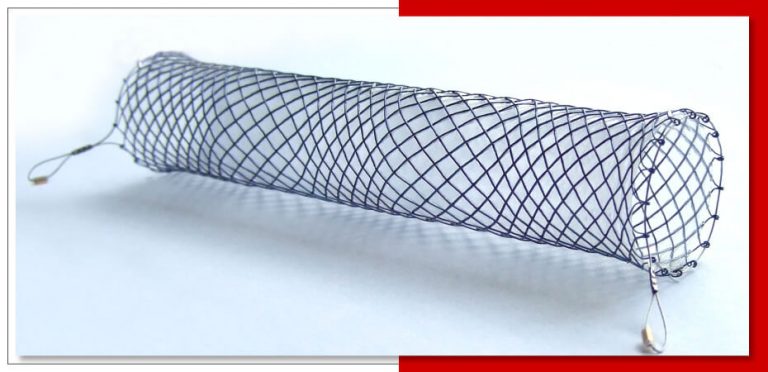 Prótesis esofágicas – Dra. Thalia Ortega Escarabay – Gastroenterologo Quito